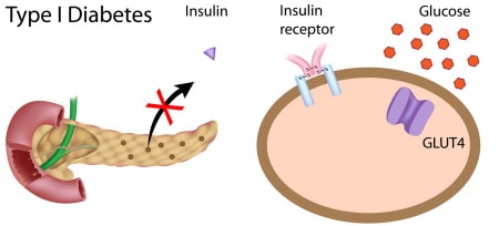 Type 2 Diabetes | Types of Diabetes